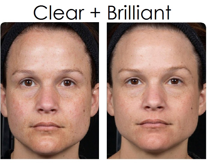 Get Your Glow Back with NEW Clear + Brilliant™ | Alexander J. Covey, MD