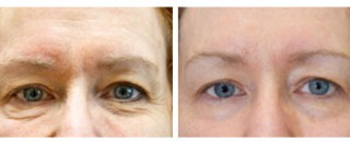 Exilis Ultra 360 Archives | Dr Covey